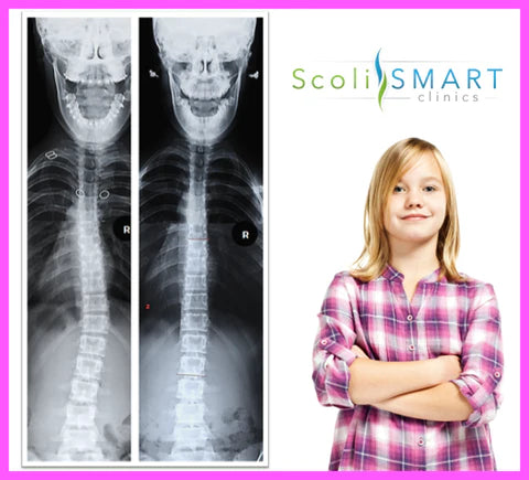 Scoliosis Causes: A Complete Understanding – BackGenius